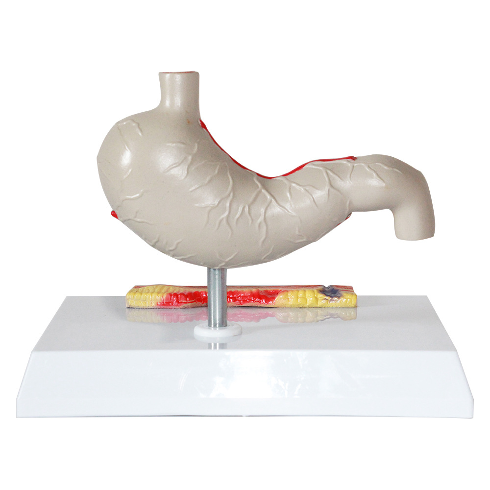 CE Certification Human Digestive System Gastric Perforation ...